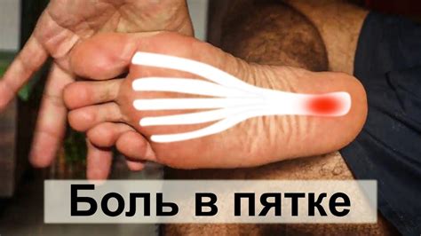 КАК БЫСТРО СНЯТЬ БОЛЬ В ПЯТКЕ? - YouTube