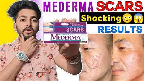 Mederma Cream | Mederma Scar Cream | Mederma Cream Ke Fayde - YouTube
