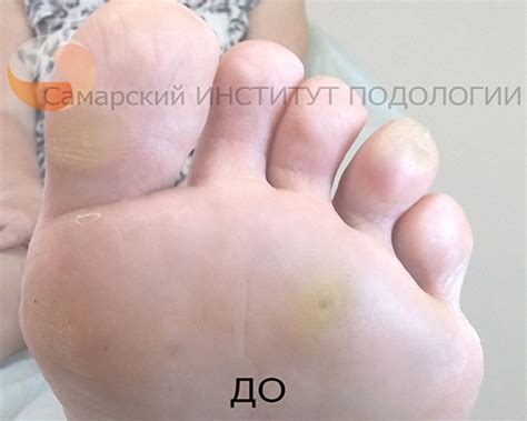 Мозоль. Описание, виды, причины и лечение мозолей