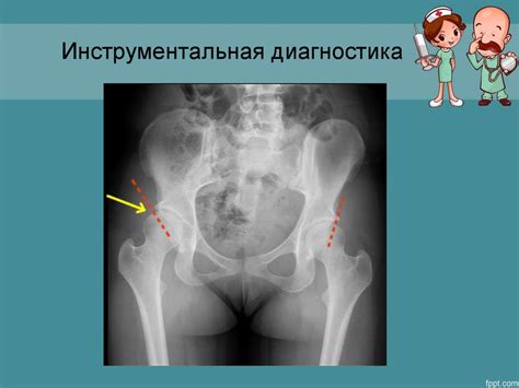Дисплазии тазобедренных суставов - презентация онлайн