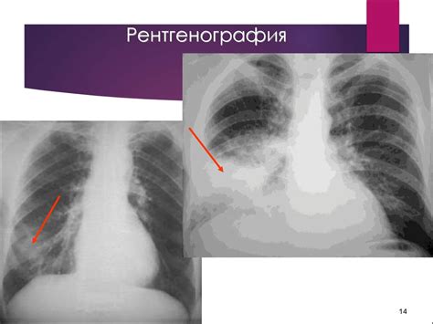 Пневмония. Пневмония деген не. Эпидемиологиясы. Этиологиясы ...