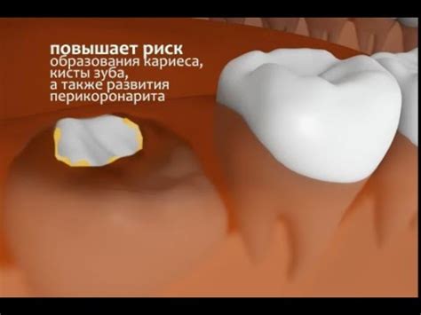 Прорезывание зубов. Прорезывание зуба мудрости - YouTube