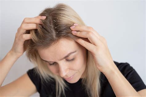 How to Treat Dandruff using the Best Anti Dandruff Shampoos | The Juice ...