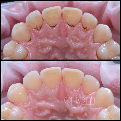 Профессиональная чистка зубов под микросокопом - Ortom lounge dental clinic