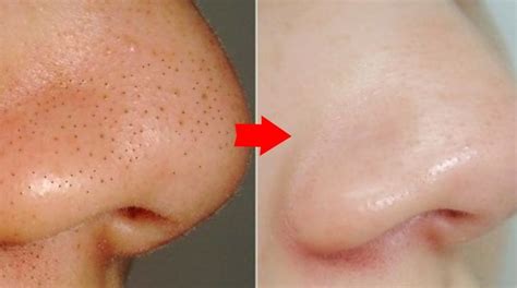 Маски от черных точек своими руками 25032019 | Pore cleansing ...
