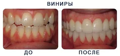 Композитные и керамические виниры на зубы, цена виниров
