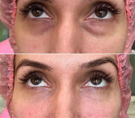 MESOEYE С71 (Мезоай) – обзор препарата + отзывы, стоимость, фото до и после