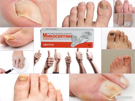 Микосептин: инструкция по применению, цена и аналоги, отзывы о препарате