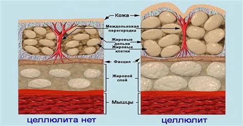 Вот, как избавиться от целлюлита быстро и просто! Эти методы дают 100% ...