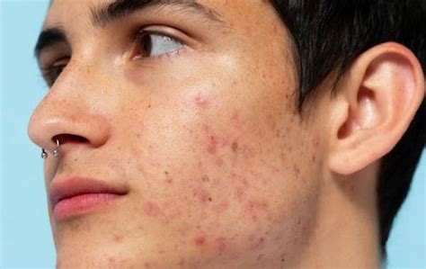 Apa itu Blemish? Pengertian, Penyebab dan Cara Mencegahnya