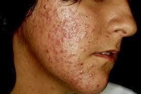 Tratamiento con Sabila para el Acne - Paperblog