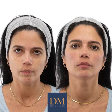 Treatment Gallery | Botox & Dermal Filler Training Courses | Derma ...