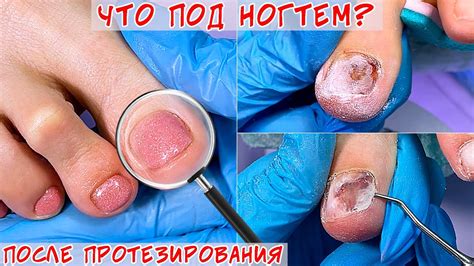 Протезирование ногтевой пластины / Три недели спустя - YouTube