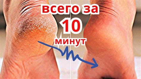 10 минут и Натоптышей Мозолей трещин на Пятках как не бывало Простой ...