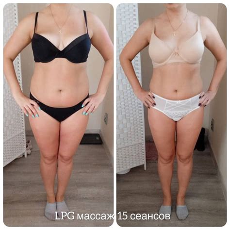 LPG — аппаратный вакуумно-роликовый массаж. Аппликатор захватывает ...