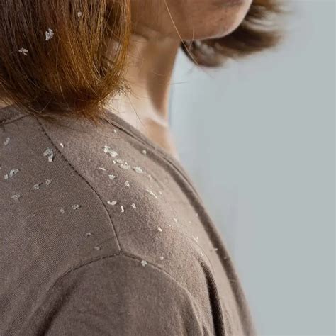 Dandruff Shampoo: What Is It and How Does It Work?