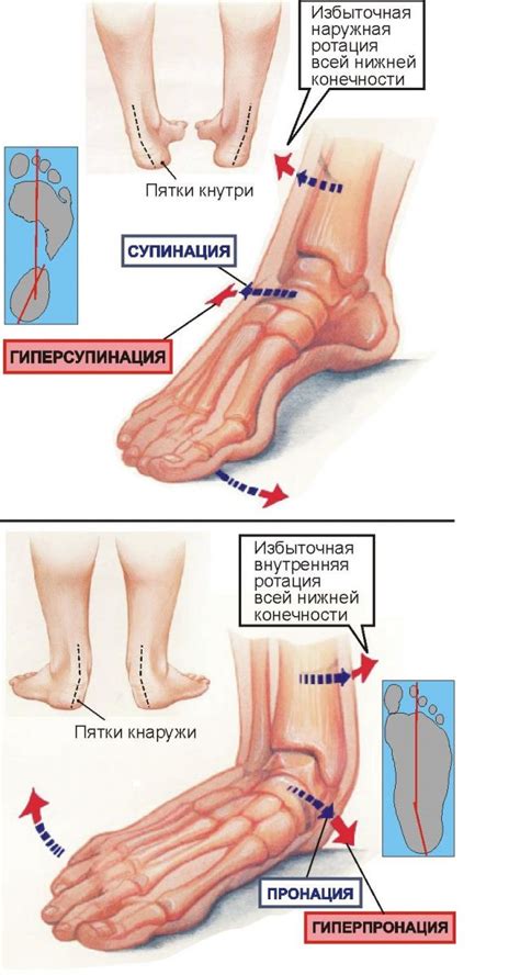Все, что нужно знать бегуну об избыточной пронации (гиперпронации)
