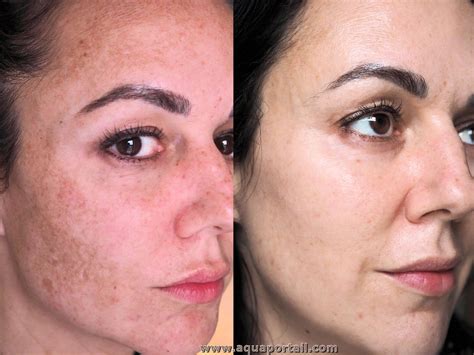 Hydroquinone : définition et explications