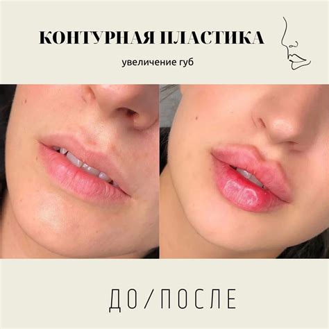 Виды увеличения губ по форме фото и названия