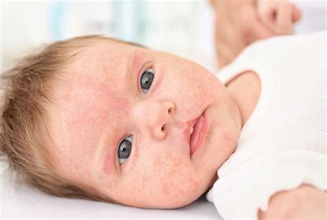 Atopik Dermatit | Molekülce Bilimsel Kaynak Platformu