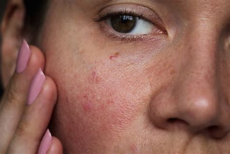Having Sensitive Skin? Say Goodbye to Allergies!