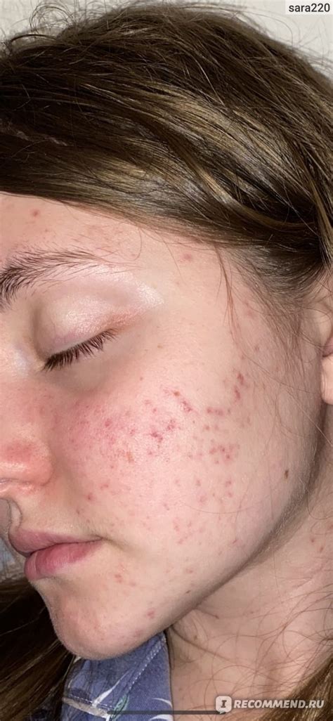 Крем ARAVIA Корректор азелаиновый Azelaic Correcting Cream ...