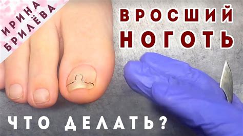 Вросший ноготь на ноге ⚡ЧТО ДЕЛАТЬ? Советы профессионала - YouTube