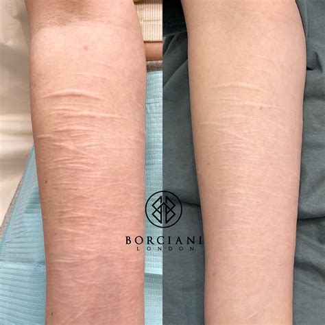 Scar Treatments and Removal in London - Borciani Clinic
