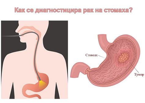 Как се диагностицира рак на стомаха? - ArsMedica.bg | Paks, Ha?