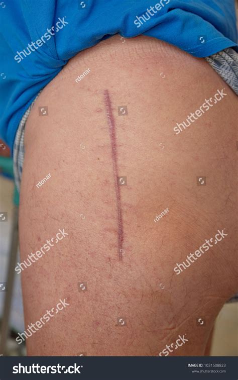 Devastated hip joint : 22 images, photos et images vectorielles de ...