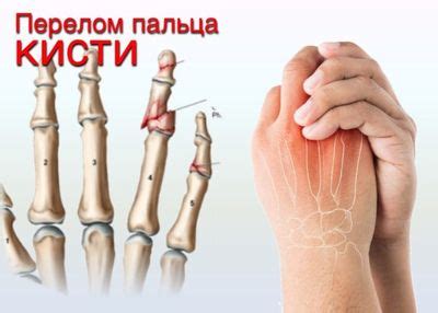 Перелом мизинца или большого пальца на руке: причины травматизации ...