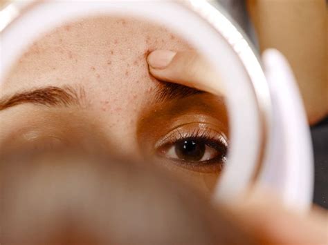 Pimples Around Eyebrows