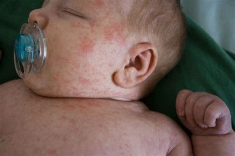 Потница у взрослых и детей: симптомы и лечение в домашних условиях