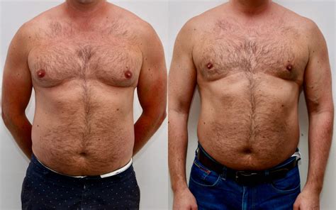 Gynecomastia Surgery | Male Breast Reduction Edinburgh