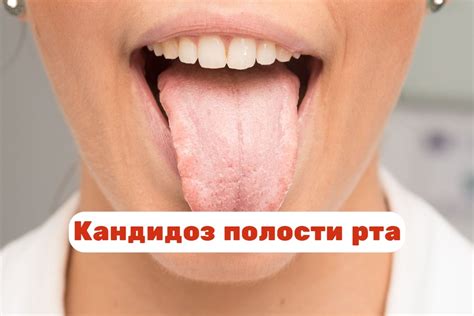 Кандидоз полости рта: причины и лечение кандидоза полости рта