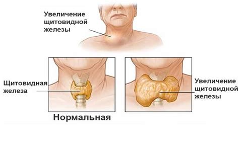 Свечи от геморроя анестезол: состав, свойства, противопоказания ...