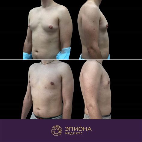 Гинекомастия в бодибилдинге (гино), препараты от гинекомастии