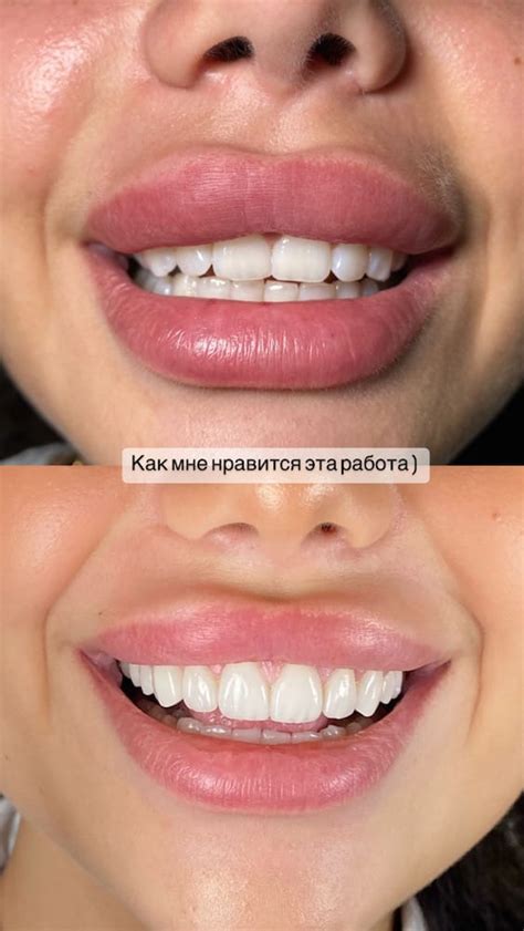 Виниры: виды, особенности установки, безопасность, показания и ...