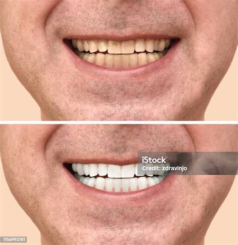 Gigi Seorang Pria Sebelum Dan Sesudah Perawatan Gigi Foto Stok - Unduh Gambar Sekarang - iStock