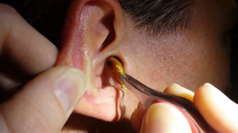 Top 5 Disgusting Ear Wax Removals - YouTube