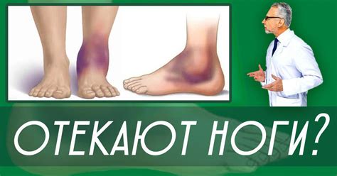 Что делать при отеках