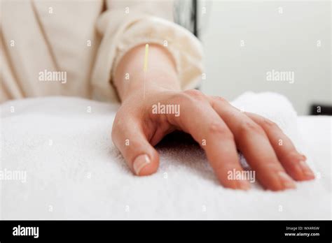 Acupuncture needle in LI4 (large intestine 4) point Stock Photo - Alamy