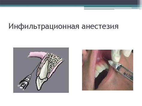 Местная анестезия Местная анестезия обезболивание тканей