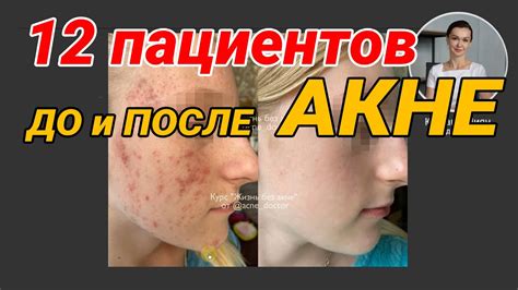 12 пациентов с АКНЕ. До и После - полный обзор - YouTube