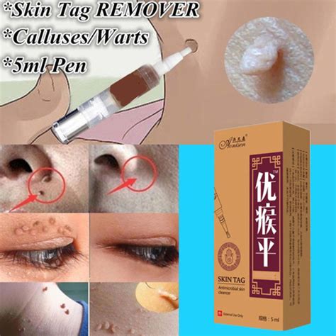 Warts Mole Remover Serum Pen Wart Treatment Pen Skin Tags Removing ...
