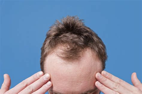 Седства от облысения у мужчин: народные рецепты, таблетки и препараты ...