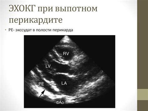 Перикардиты - презентация онлайн