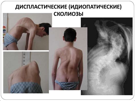Сколиоз, классификация сколиоза - презентация онлайн