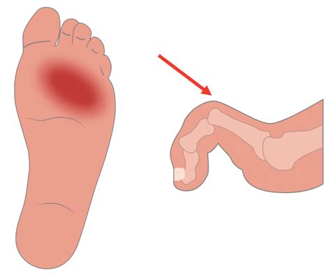 Hallux Valgus : définition, évolution et opération