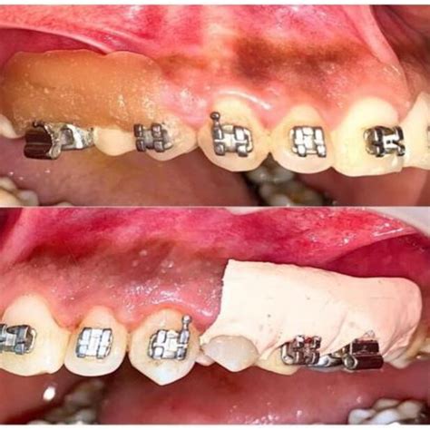 Dispensing of Pre-mixed Reso-Pac periodontal dressing | Download ...
